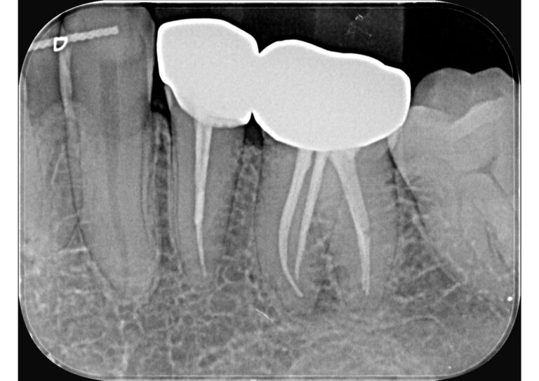 Fiber Post & Core Build-up - Belix Dental Clinic